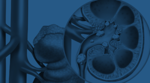 Stone Disease Pathology - Boston Scientific Urology and Pelvic Health