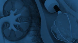 Stone Management | Boston Scientific Urology and Pelvic Health